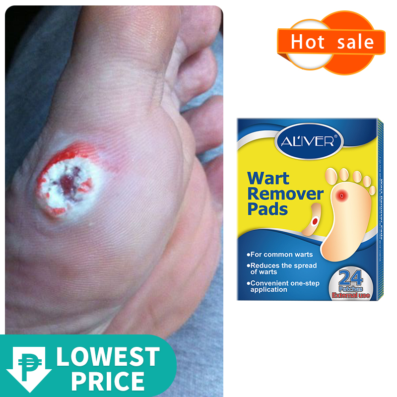 【Global select】Aliver Feet Corns Warts Removal Patch Pain Relief ...