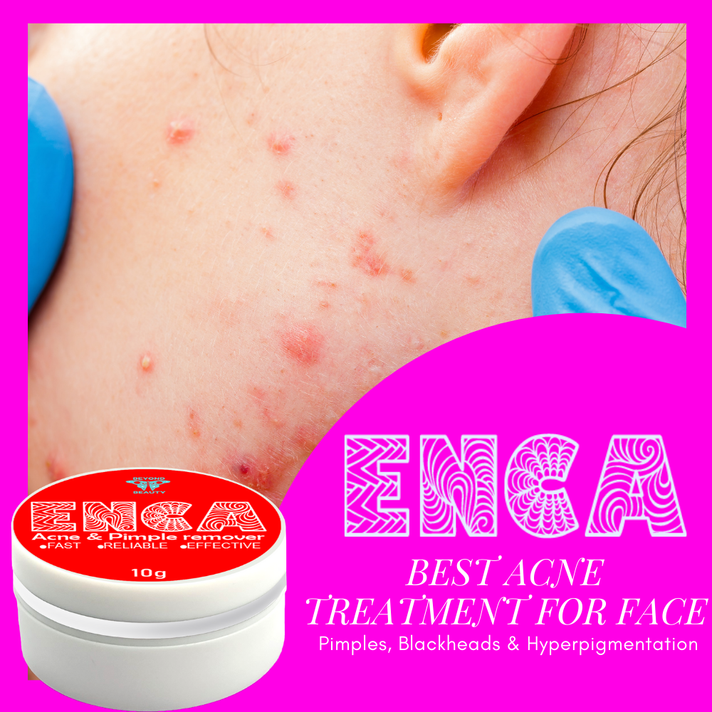 100% EFFECTIVE AND 'BEST SELLER ENCA PIMPLE AND ACNE MARKS REMOVER ...