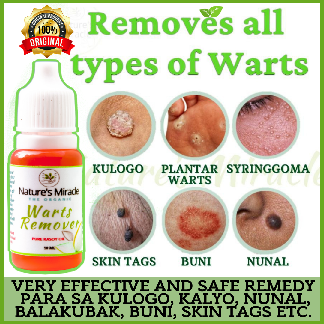 Warts Remover And Mole Remover Pure Organic Effective Original Kasoy ...