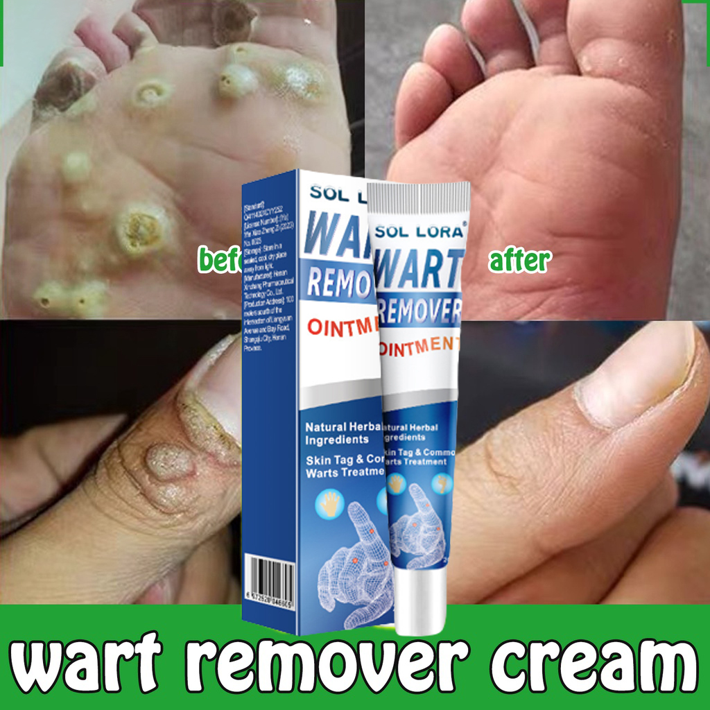 【Effective in 7 days】Warts Remover Cream Warts Magic Remover Wart ...