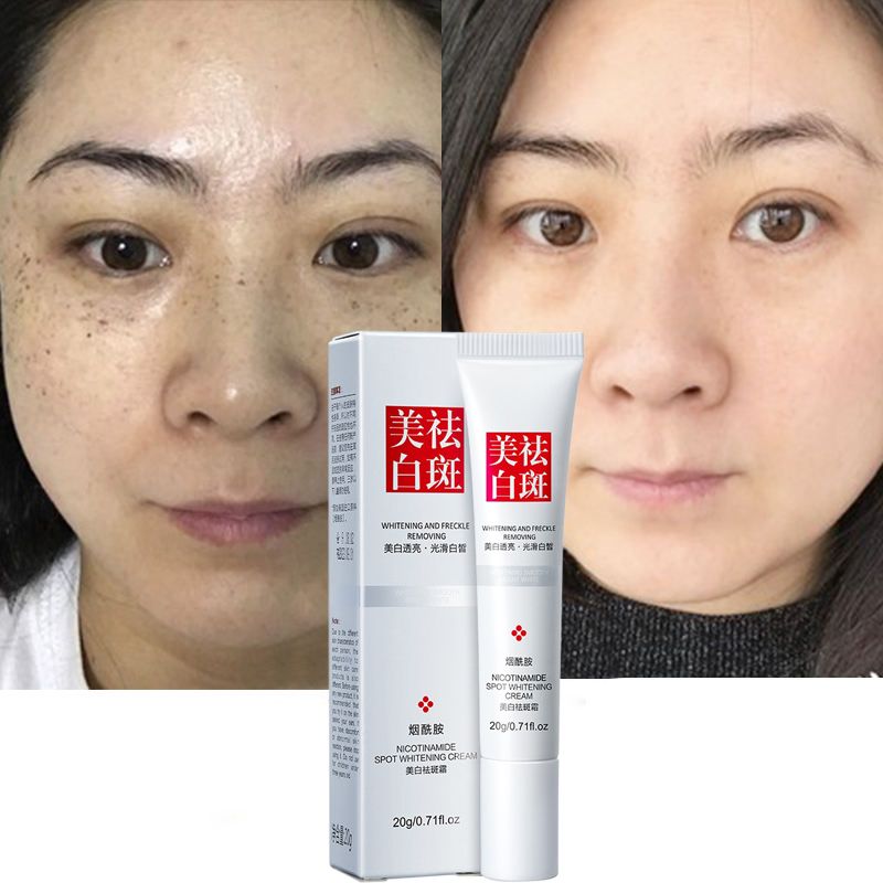 【100% effective】 Whitening melasma cream original pekas cream eraser ...