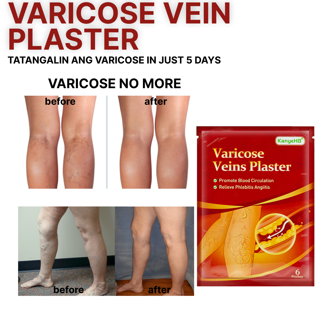 Best Seller Varicose Veins Plaster | Remove Varicose Veins Treatment ...