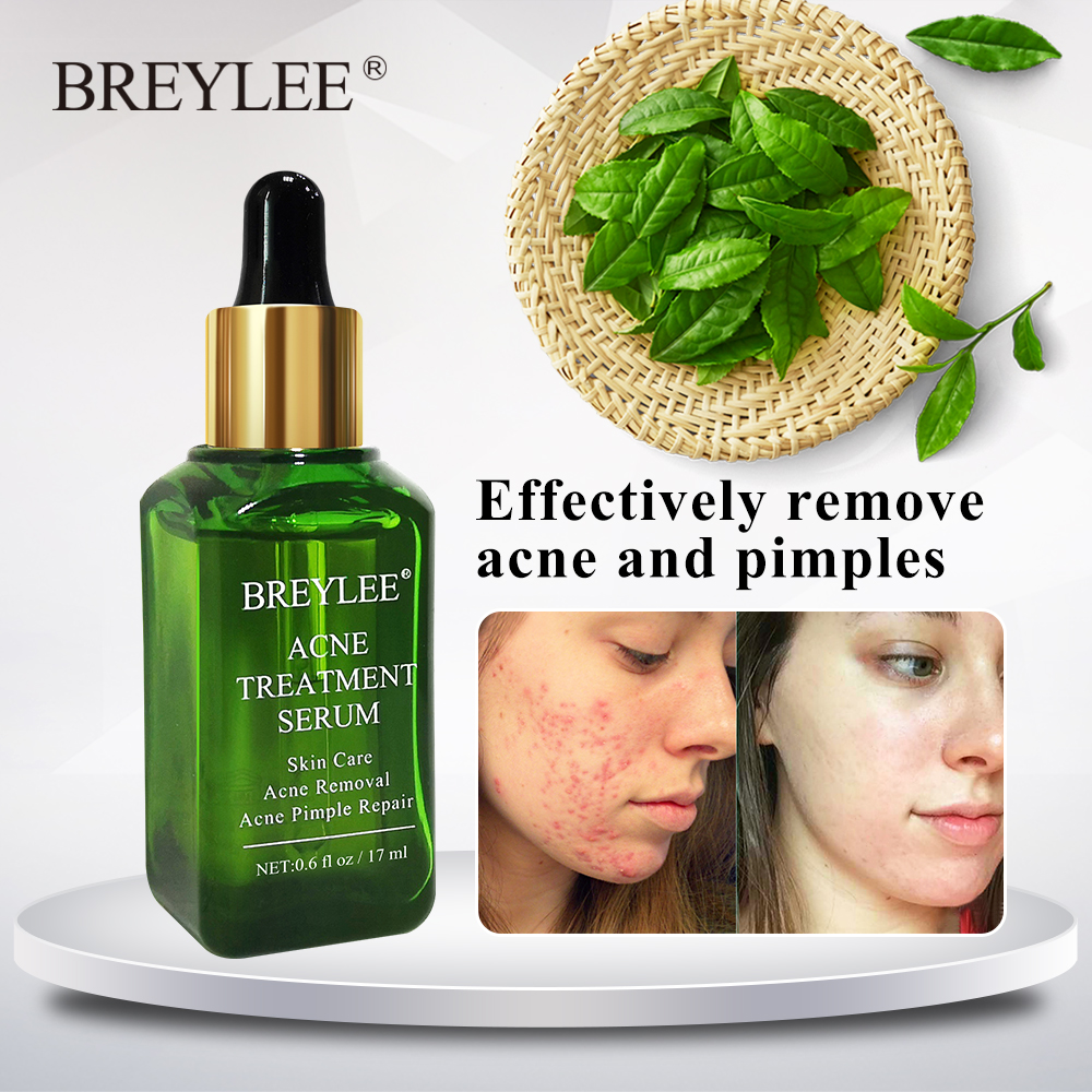 BREYLEE Facial Serum Acne Care Moisturizing Tea Tree Oil 17ML Acne Pimple Scar Removal Anti Acne ...