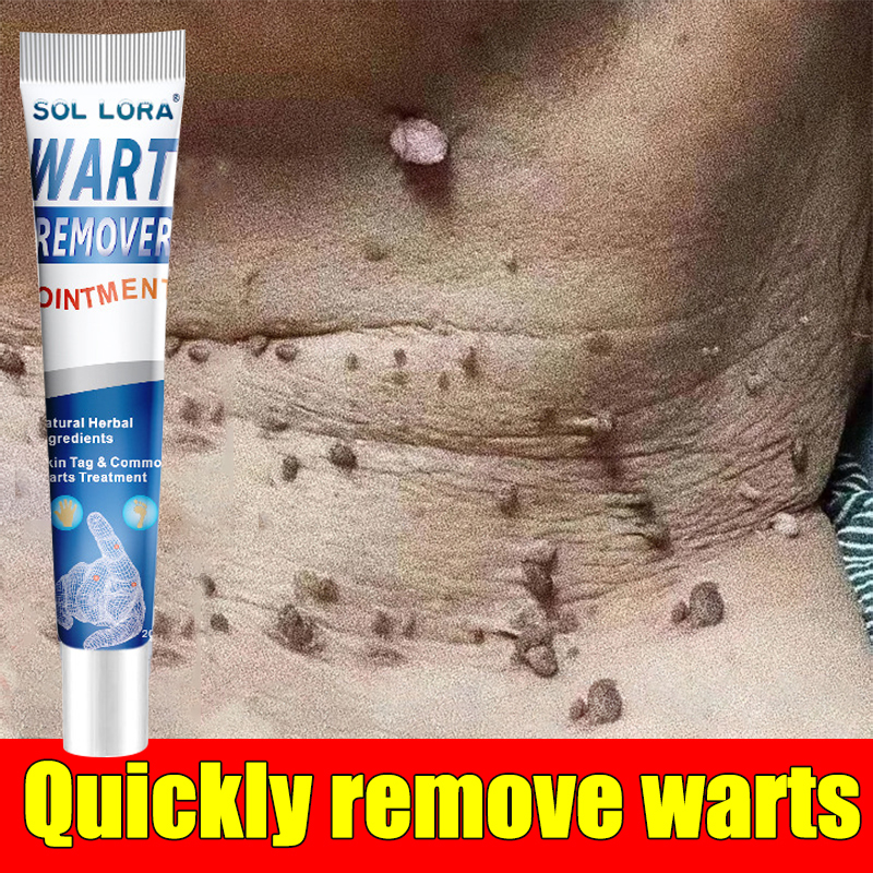 Original Wart Removal Cream Painless Wart Remover Cream Mole Remover ...