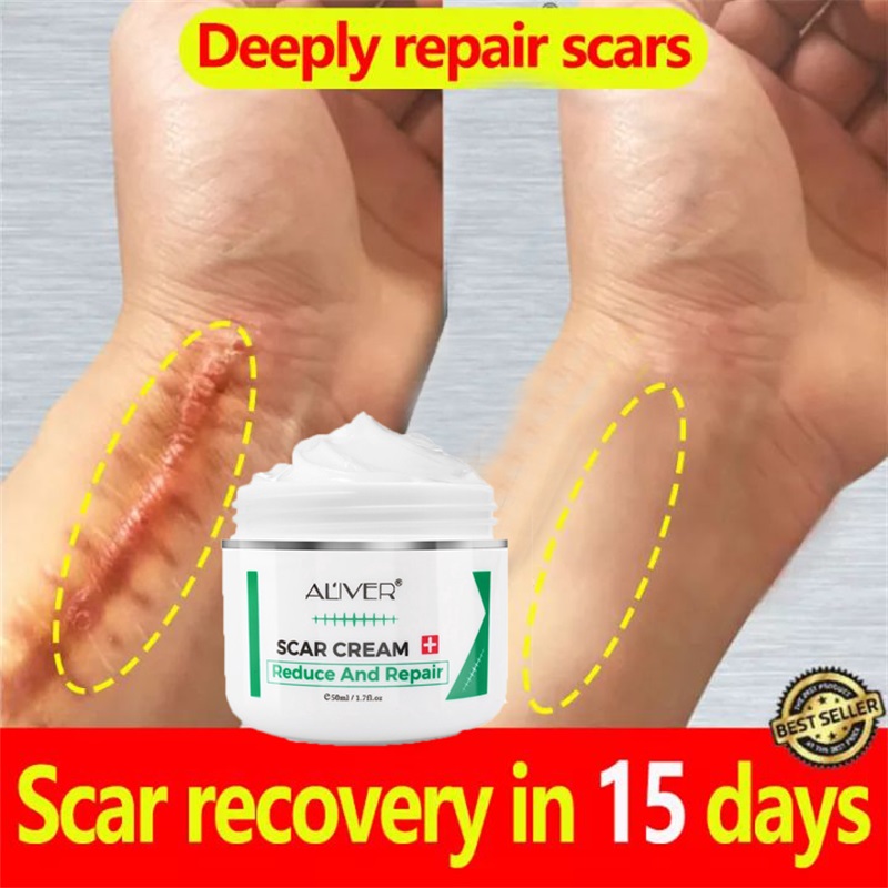 100% Authentic ALIVER Scar Remover for Old Scar on Leg 50ml Scars ...