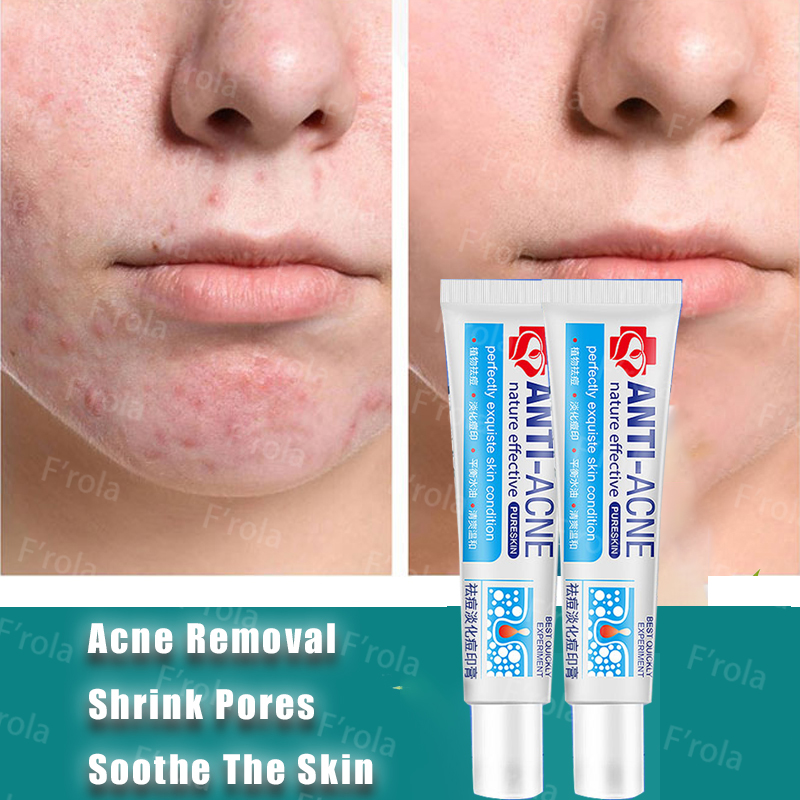 100% Effective Remove Pimples Quickly Pimple Remover Acne Cream Fades Acne Marks Repairs Acne ...