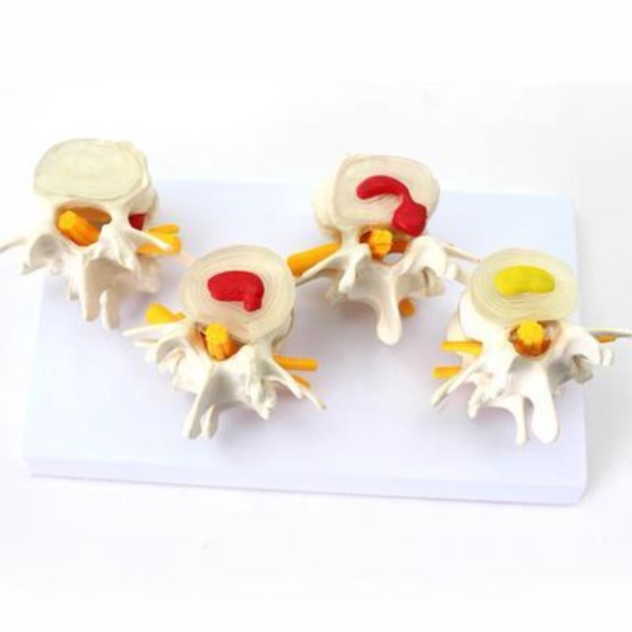 Normal medical lumbar spine lesions combination model of intervertebral ...