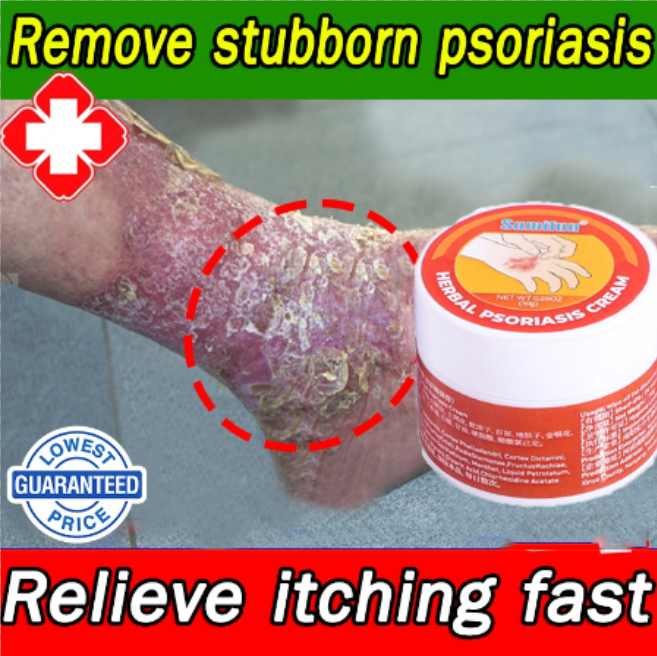 Skin Disease Ointment Sumifun Skin Fighter Cream Original Eczema Cream Skin Disease Ointment Sumifun Skin Fighter Cream Original Eczema Cream