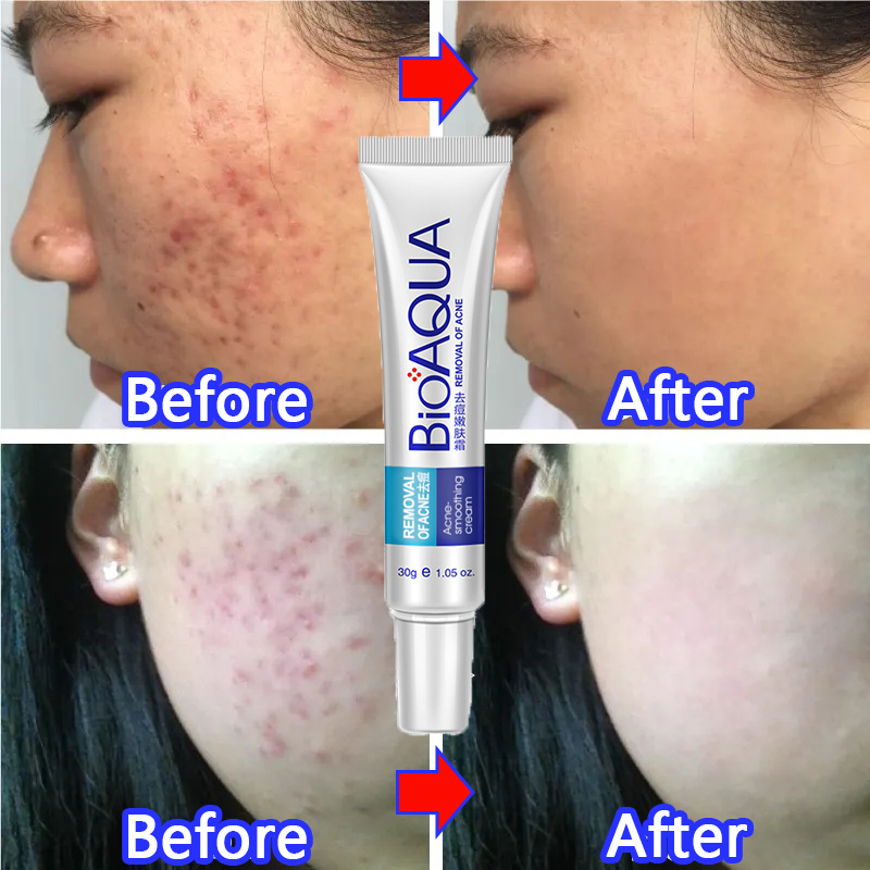 Acne Removal Scar Marks Cream pimple remover blackhead remover acne ...