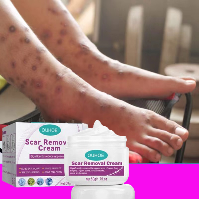100% effective scar removal cream 50g peklat remover legit scars ...