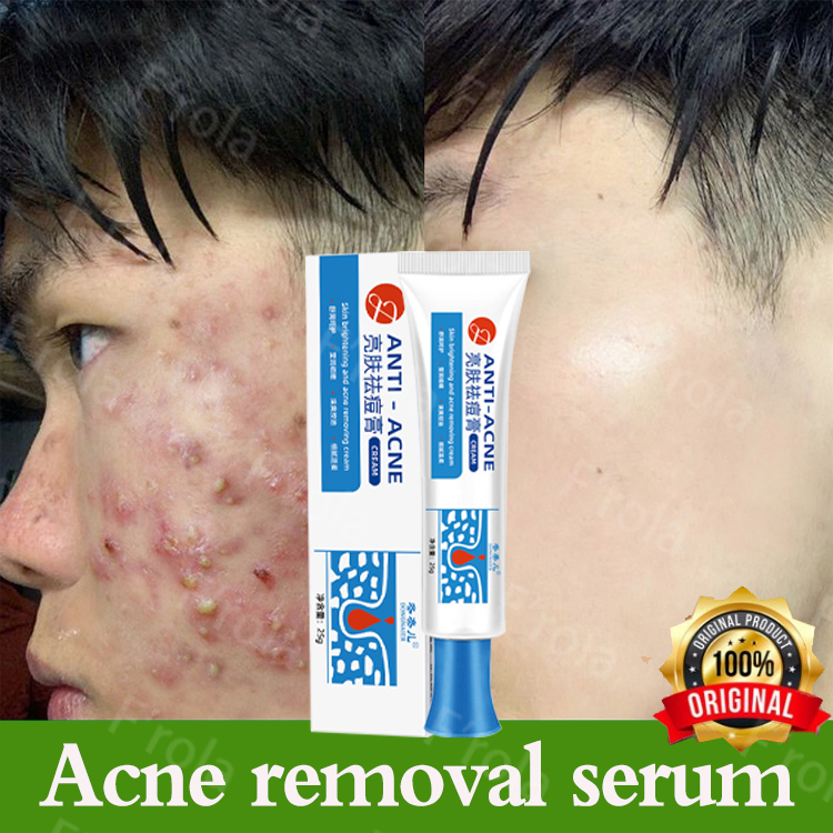 100% Effective Remove Pimples Quickly Pimple Remover Acne Cream Fades Acne Marks Repairs Acne ...