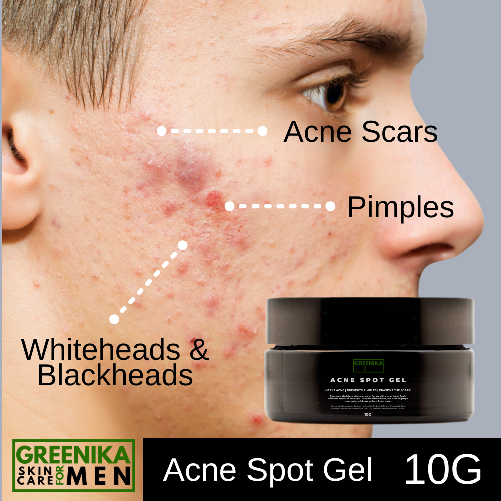 [ PIMPLE REMOVE FOR MEN ] Greenika for Men Acne Spot Gel Anti-Acne Gel ...