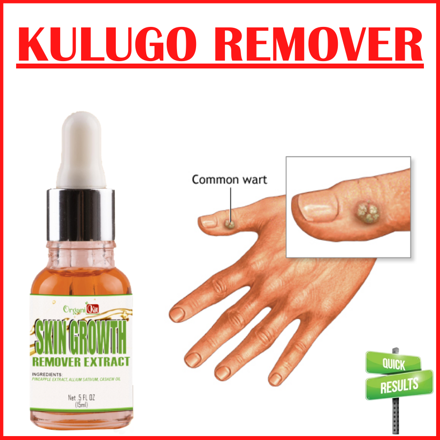 KULUGO REMOVER Skin Growth Remover Extract , kulugo remover original ...