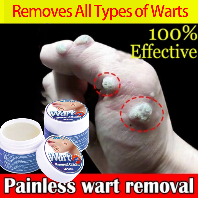 Warts Remover Original Cream Warts Magic Remover Wart Ointment Original ...
