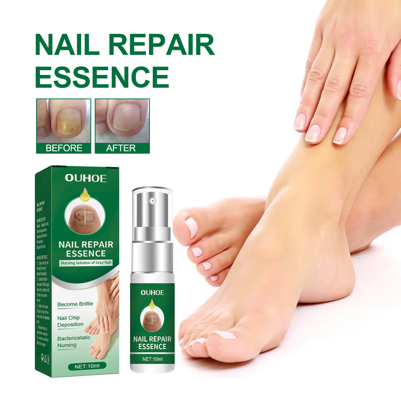 Toenail Repair Essence Gray Nail Soft Nail Yellow Thickening Concave ...