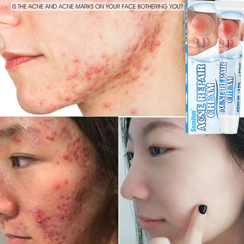 Sumifun Acne Repair Cream Acne Treatment Cream Pimple Marks Remover ...