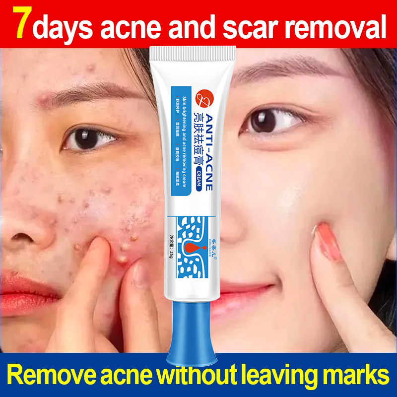 Acne Repair Cream Original 100% Effective Remove Pimples Quickly Pimple Remover Acne Cream Fades ...