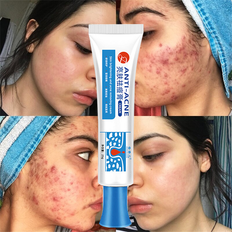 100% Effective Remove Pimples Quickly Pimple Remover Acne Treatment ...