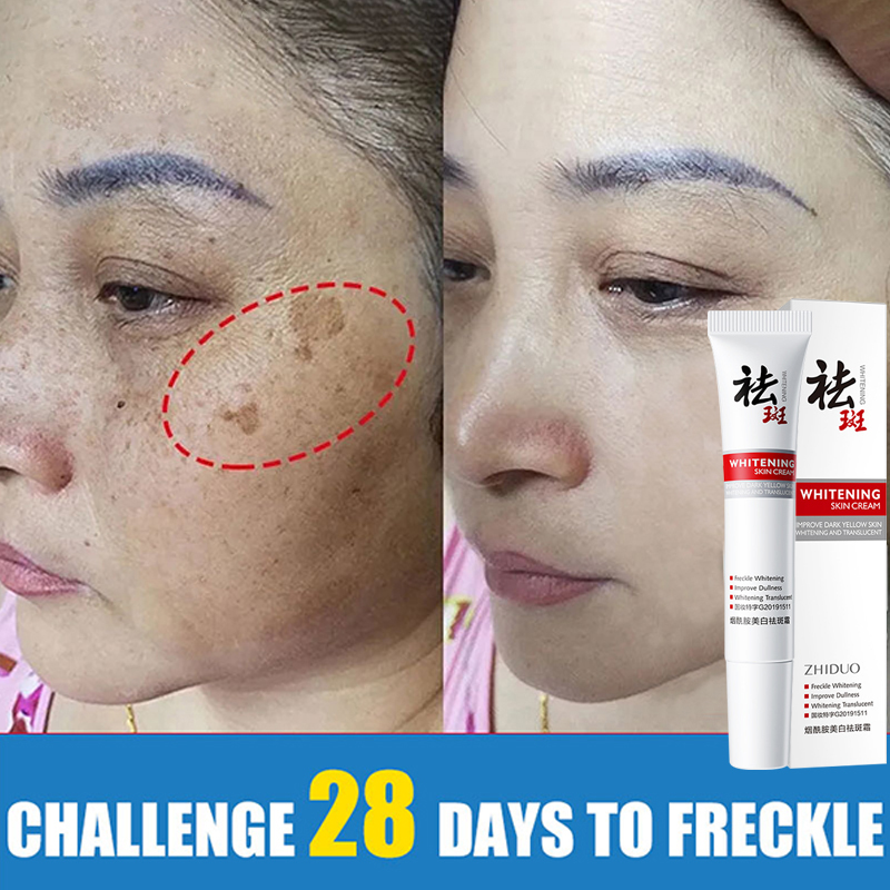 Melasma removal cream Freckle removal whitening cream Darkspot remover ...