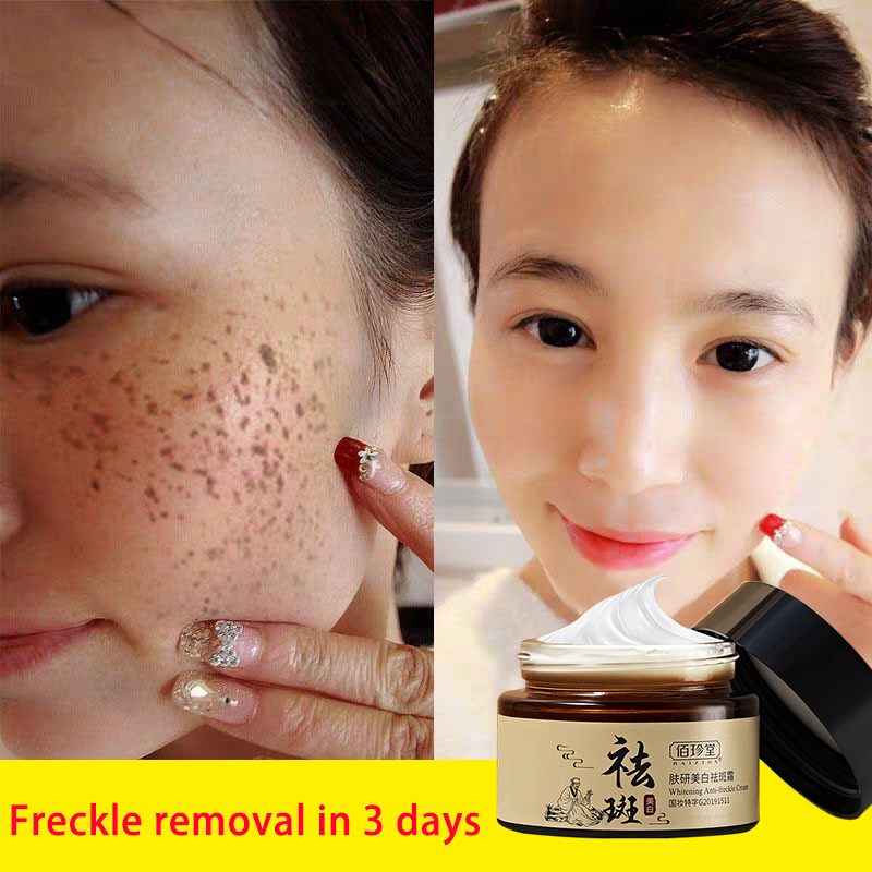 100% Effective Melasma Cream Original Melasma And Pekas Remover ...