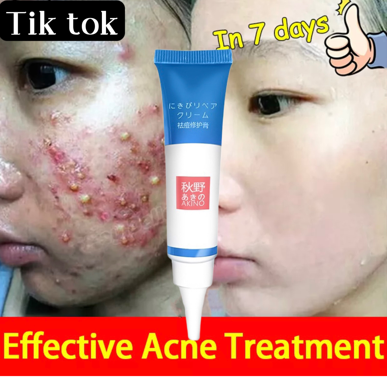 Remove Pimples Quickly Acne gel scar remover Pimple Remover Acne Cream Fades Acne Marks Repairs ...