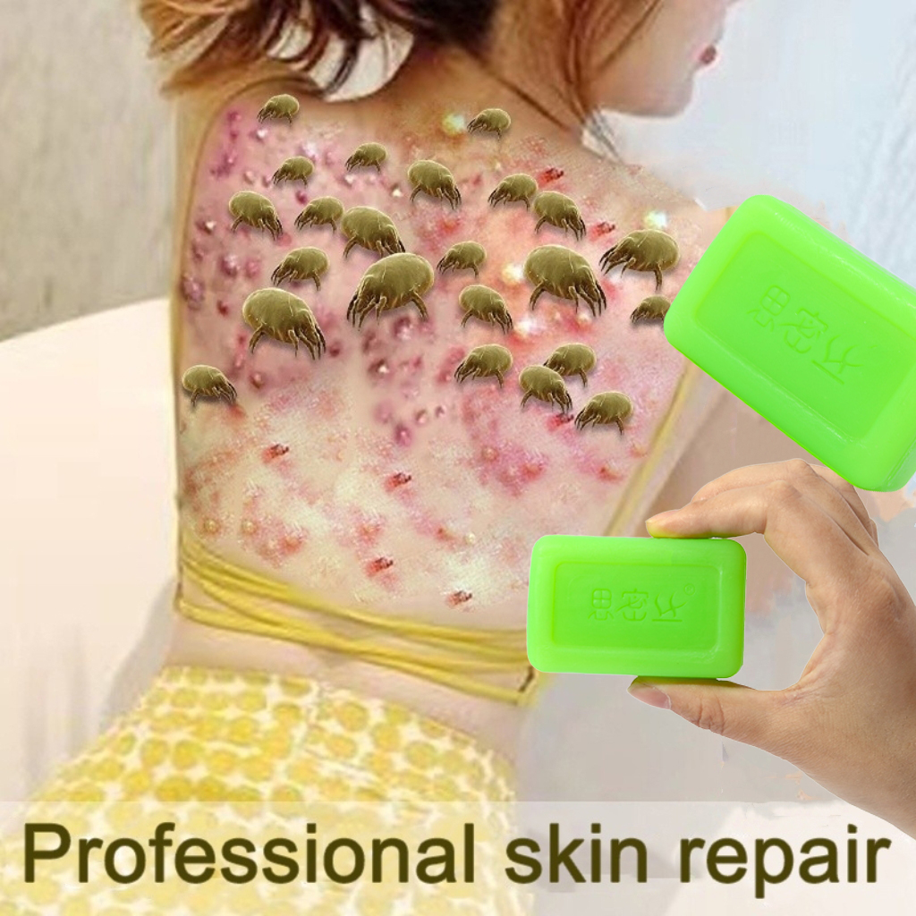 Mite Removing Mugwort Soap Anti Fungus Acne Psoriasis Seborrhea Eczema ...