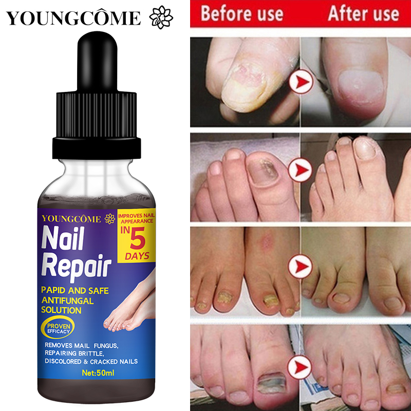 YOUNGCOME 100% Effective Nail Fungus Treatment Serum Footurel Gel Anti ...