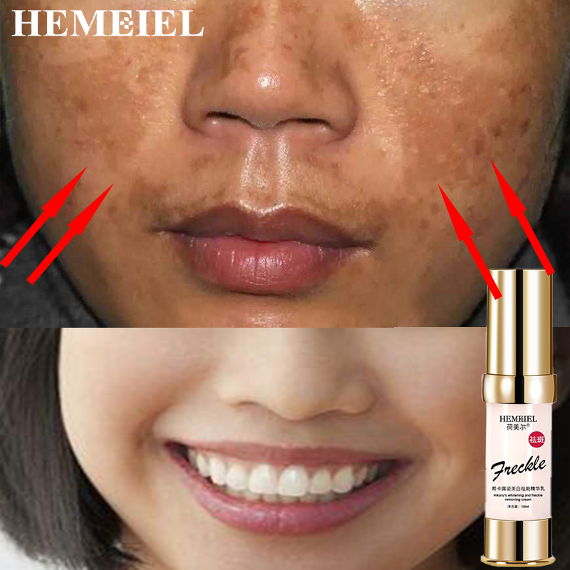 HEMEIEL Olee White Clean Melasma/Pekas Remover Cream Original/Melao ...