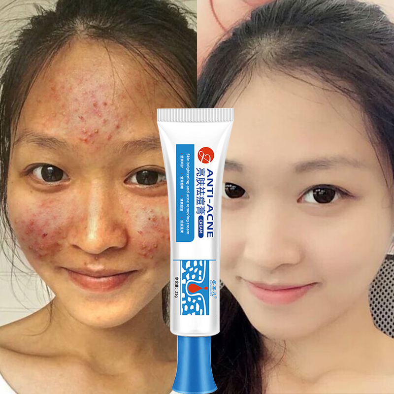 100% Effective Remover acne pimples Cream Fades Acne Marks Repairs Acne Pits Facial Scar Care ...