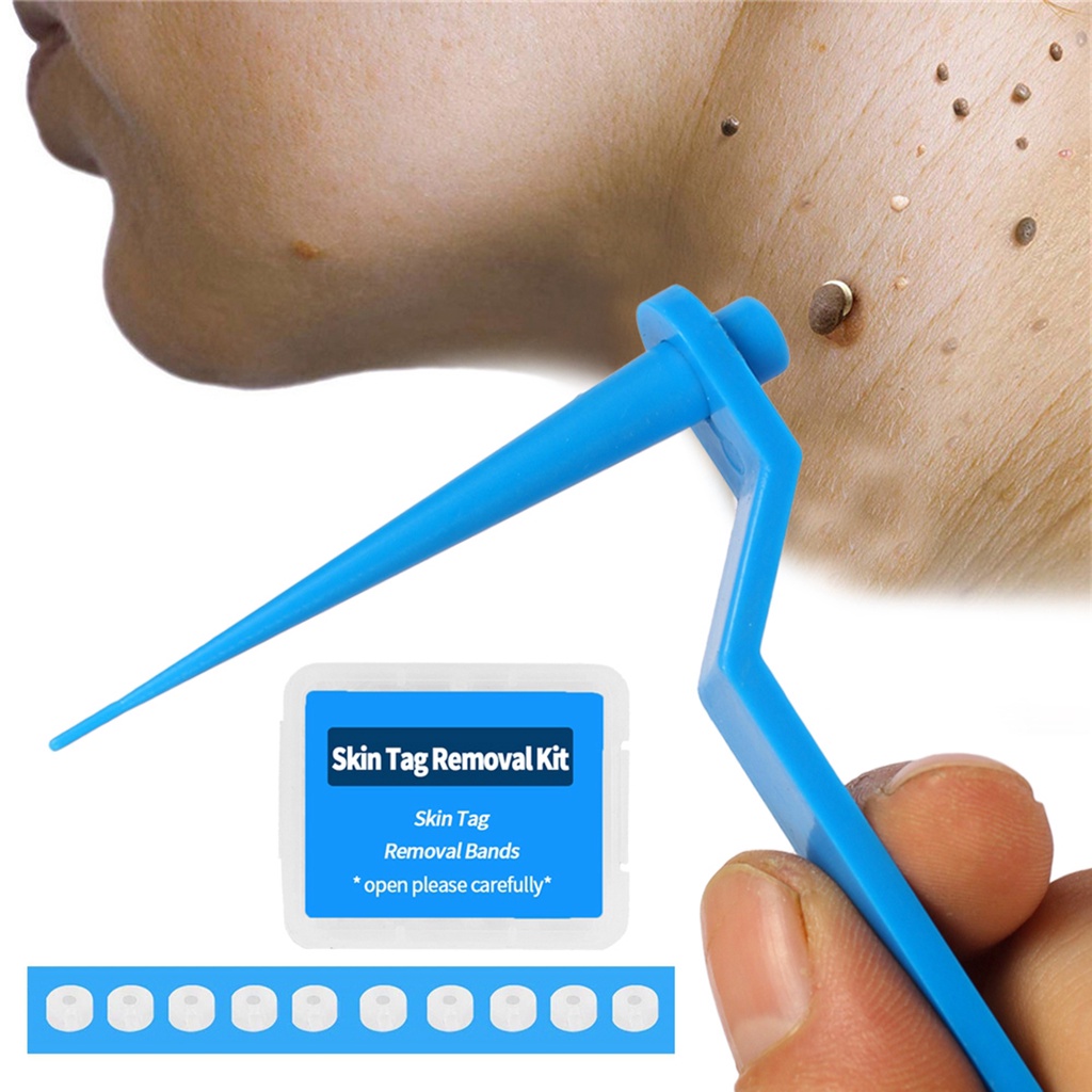 Skin Tag Removal Kit Kill Skin Mole Wart Remover Micro Band Remove Skin ...