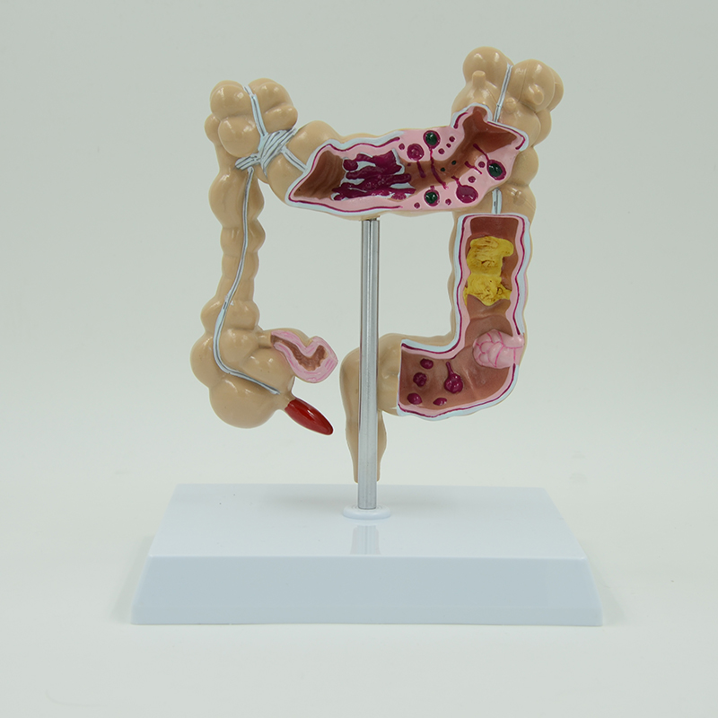 Diseased Colon Model Large Intestine Anatomical Model Digestive System ...