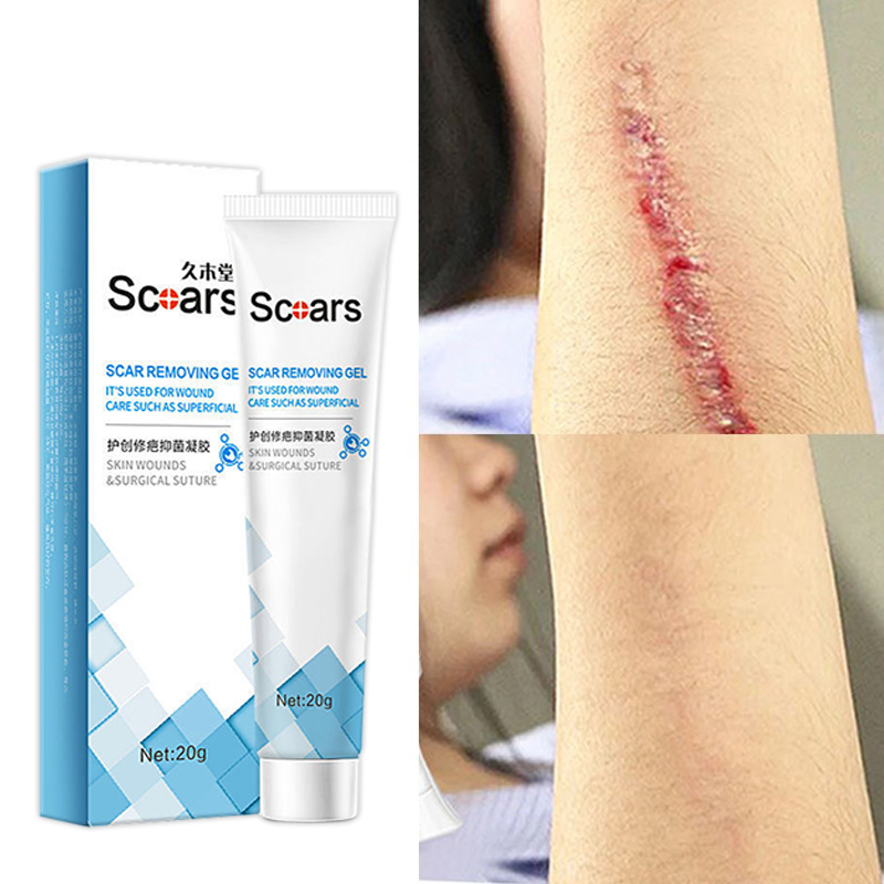 Scar remover for old scar on leg Old Scar Scar Remover Cream Remove ...