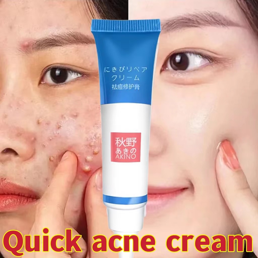 Remove Pimples Quickly Acne gel scar remover Pimple Remover Acne Cream ...