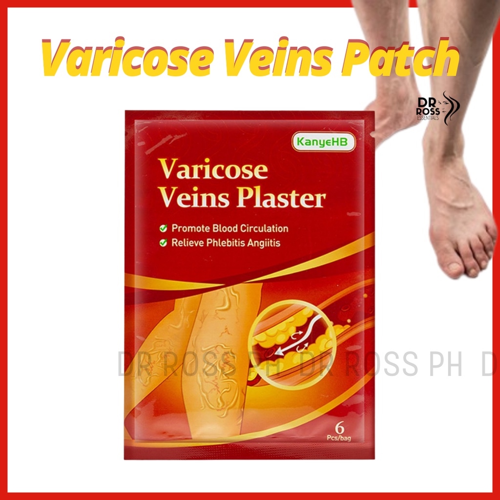 VARICOSE VEINS PLASTER | Varicose Veins Pain Relief Plaster | Herbal ...