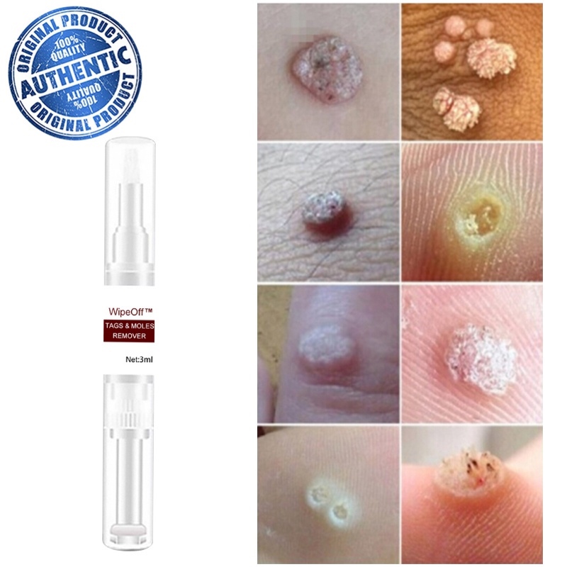 Body Warts Remover Pure Kasoy Oil Mole Skin Tag Remover Corn Plaster ...