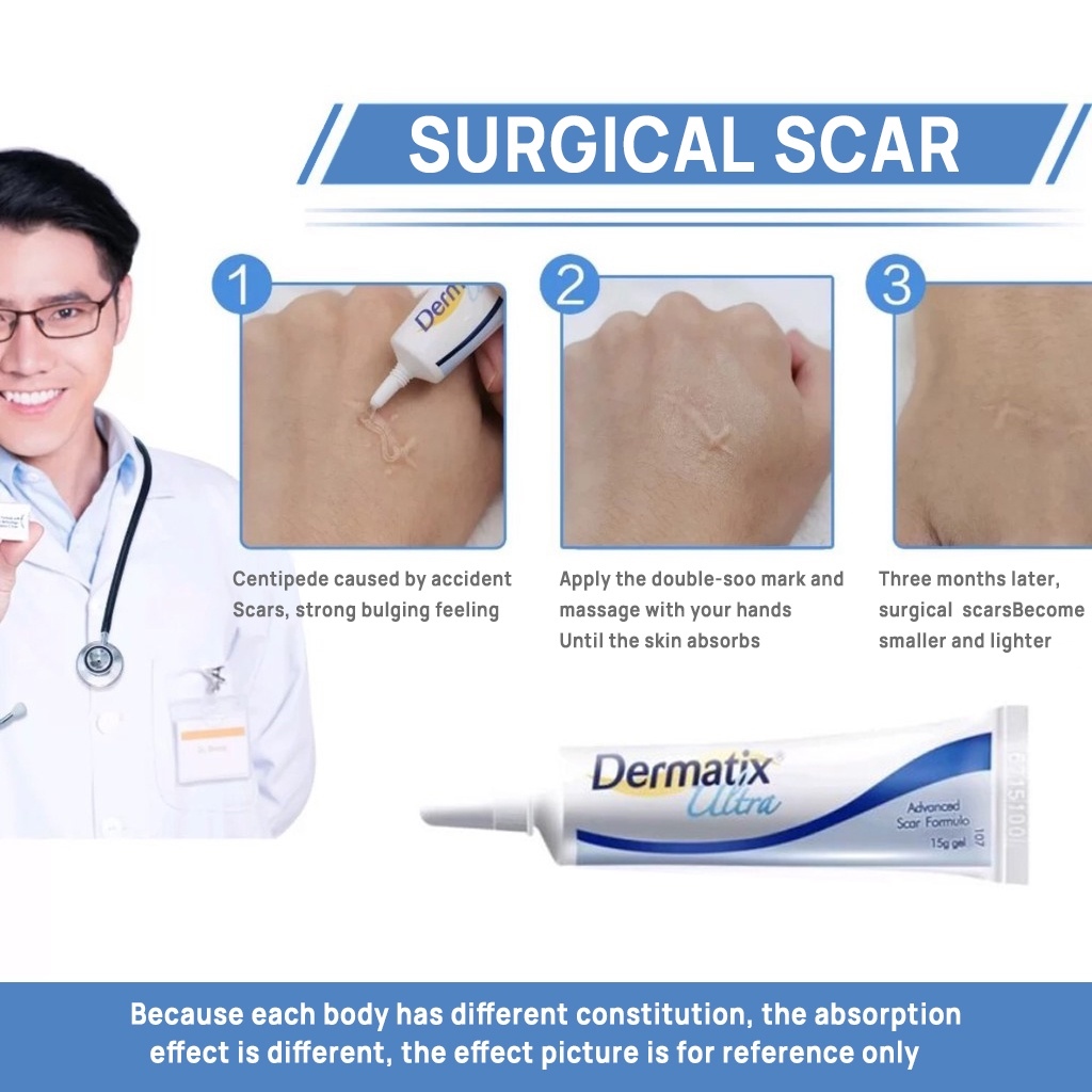 100 Dermatix ultra scar remover scar gel Australian original scar ...