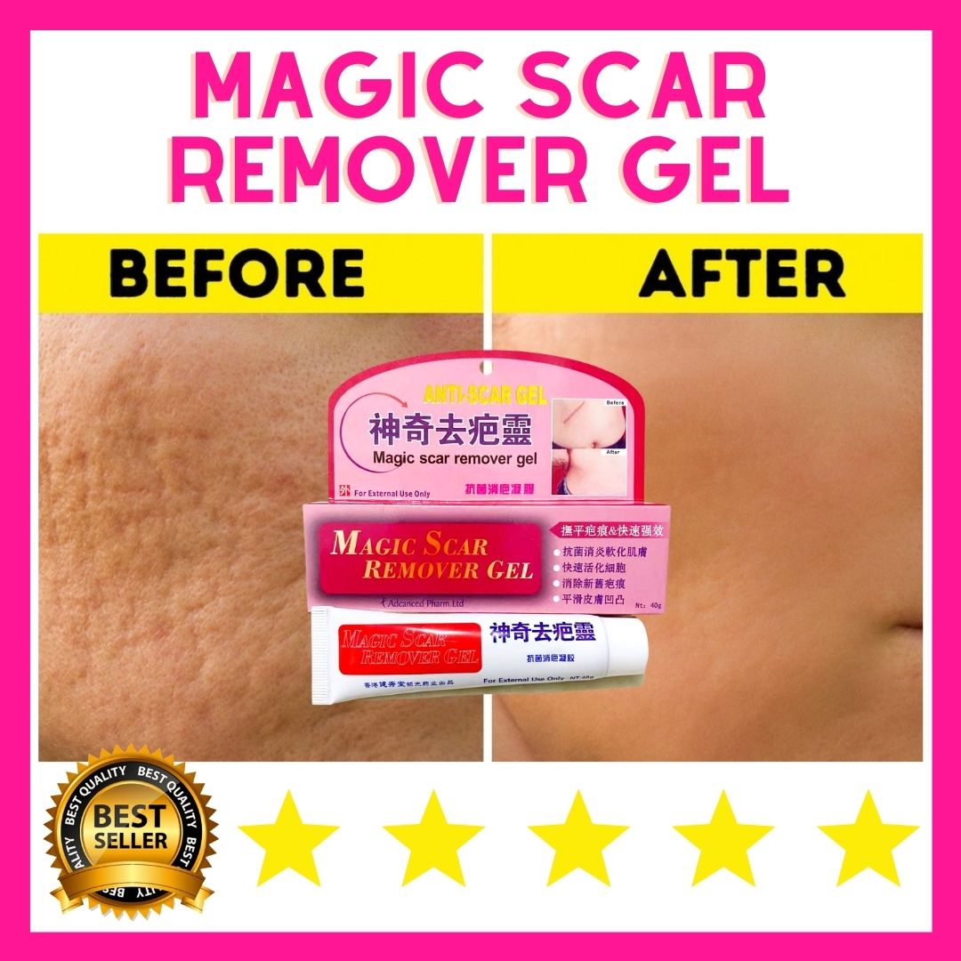 The Trends Shoppe - FLASH SALE! 100% Authentic Magic Scar Remover Gel ...