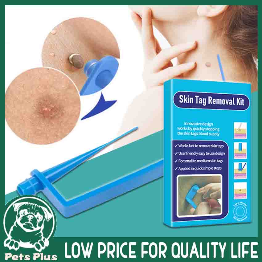 Medical Skin Tag Removal at Richard Corbett blog