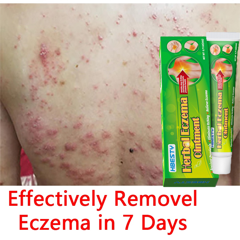 Herbal Eczema Treatment Cream Psoriasis Ointment Medicine for Itchy ...