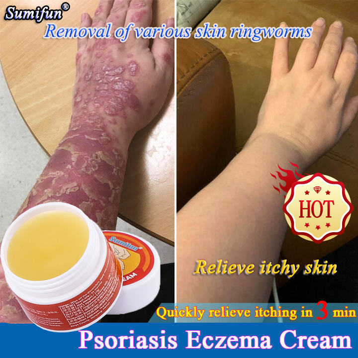 【Hot Sale】Sumifun ringworm removal ointment Psoriasis Ringworm ...