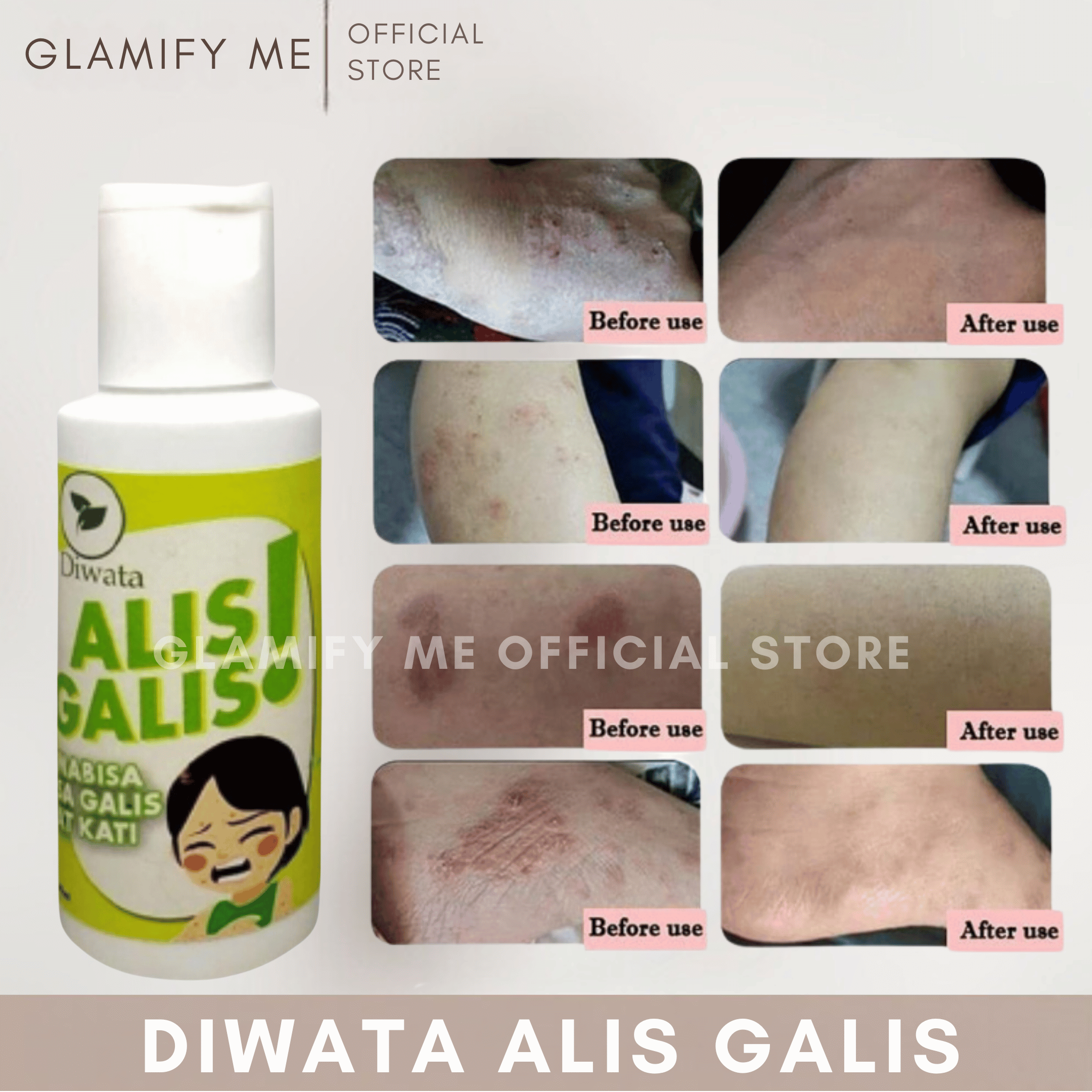 Effective Skin Itching Ointment – Diwata Alis Galis for Ringworm ...
