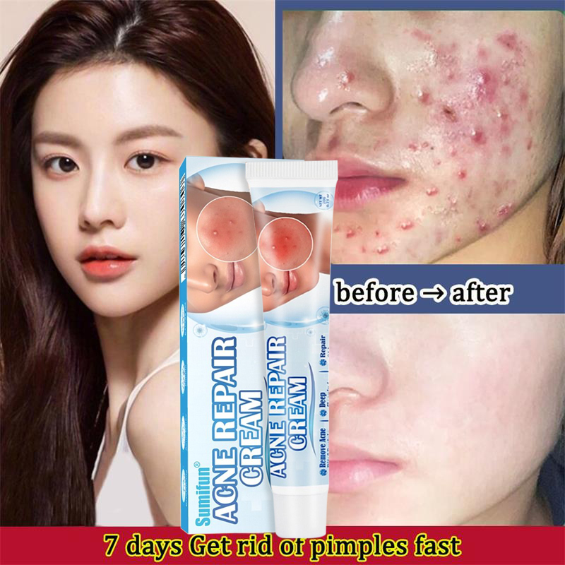 【In stock】100% Effective acne removal cream pimple marks remover cream Fades Acne Marks Repairs ...