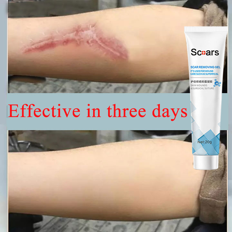 100% effective Scar removal cream Scar remover Acne Scar Removal Cream ...