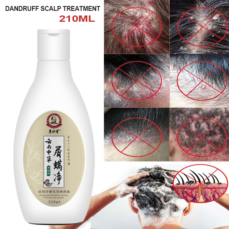 210ml Anti Dandruff Scalp Treatment Shampoo Super Effective Herbal ...