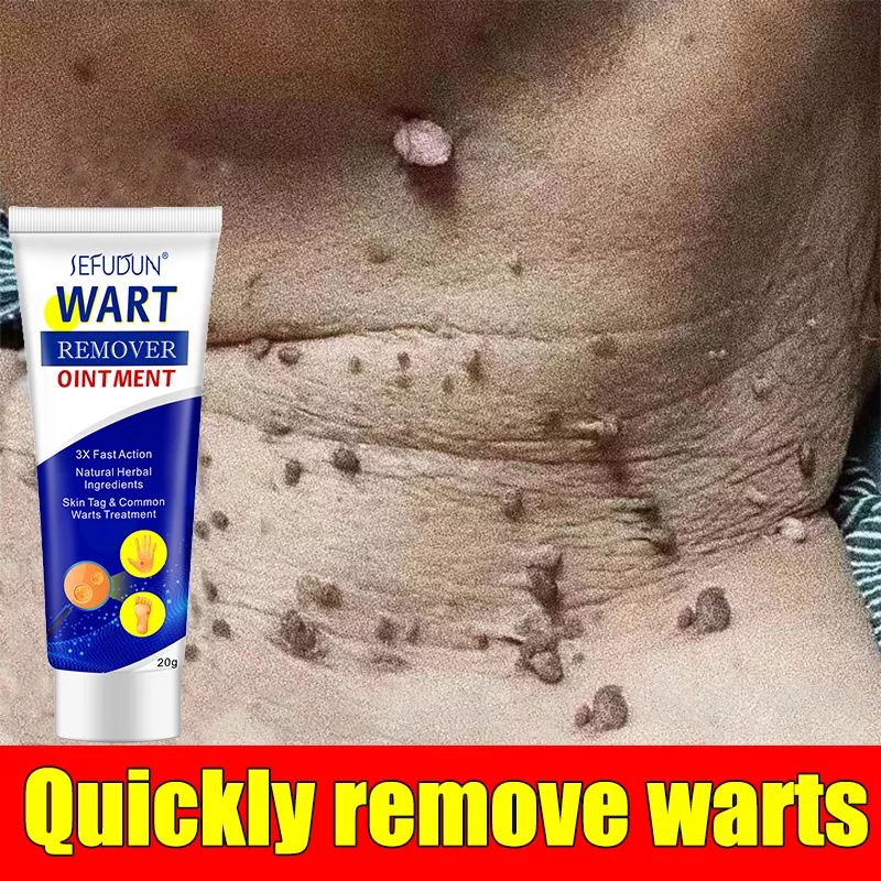 SEFUDUN wart remover ointment20gNo Pain Warts Remover All Skin Types ...
