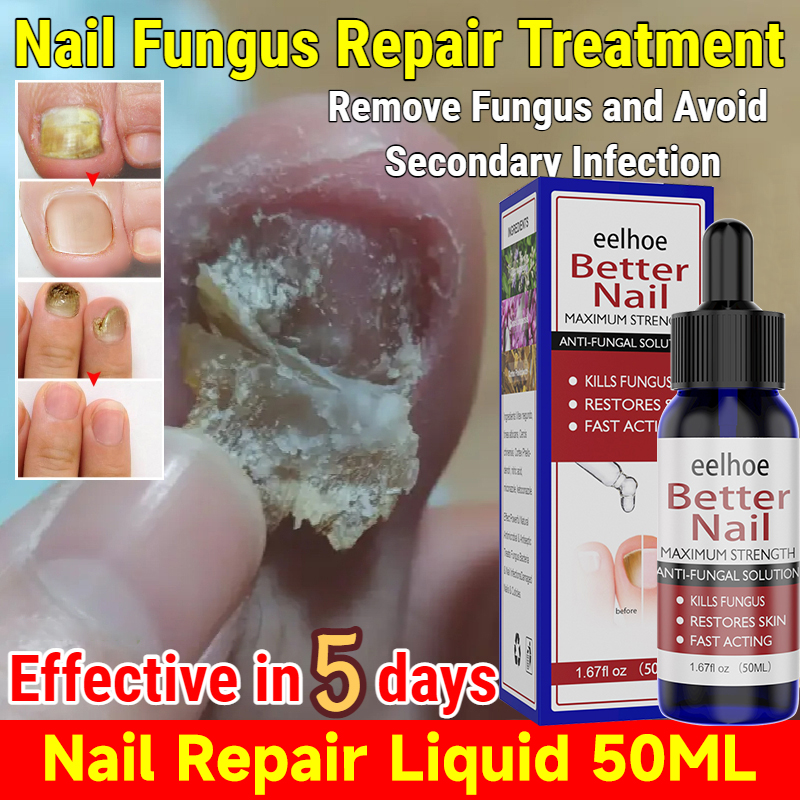 Finger Nail Fungus Treatment Singapore at Joanne Bender blog