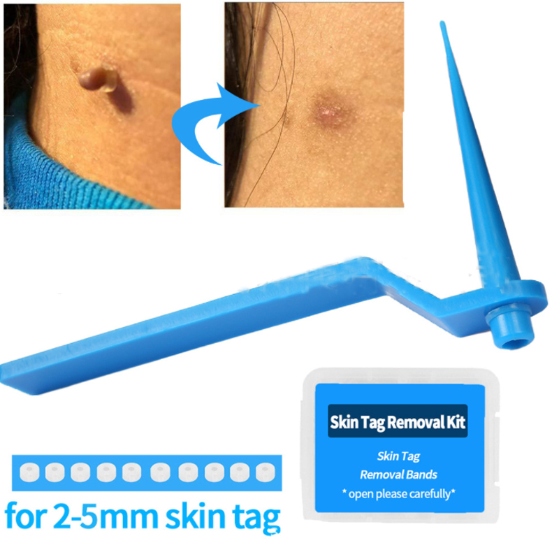 Skin Tag Removal Kit Kill Skin Mole Wart Remover Micro Band Remove Skin ...