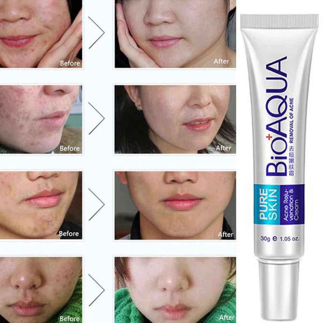 💯Original Bioaqua Pure Skin Anti Acne CREAM 30g FLASHSALE 🔥🔥 Suitable ...