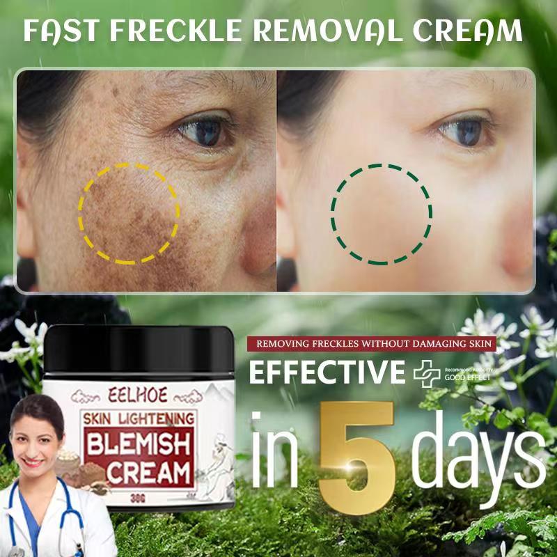 cream for melasma and pekas cream remover original pekas cream eraser ...