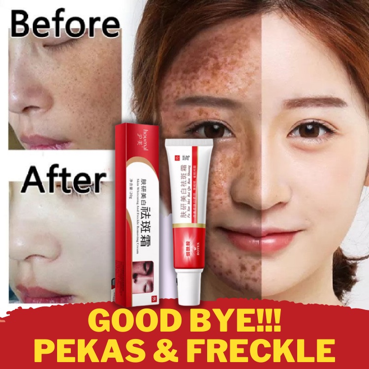 Melasma Cream Pekas Remover Collagen Japan Pekas Remover Original Pekas ...